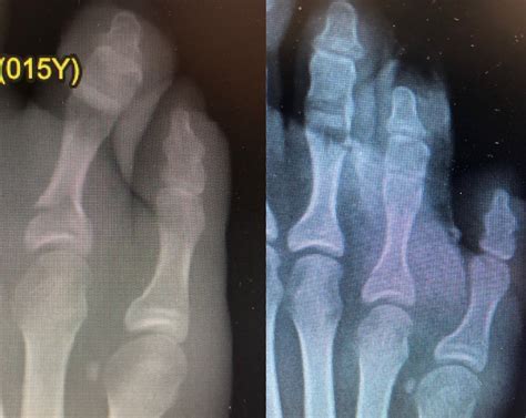 Broken Toe X Ray
