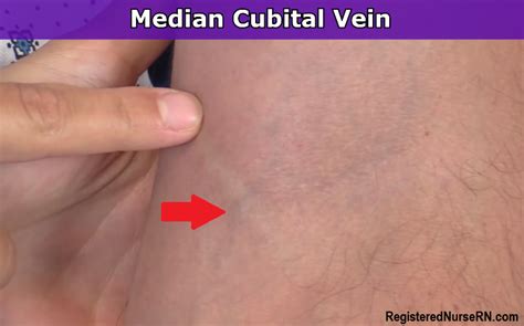 Best Veins For Iv Insertion And Blood Draws