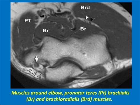Presentation1 Pptx Mri Of Elbow Joint