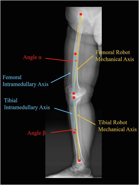 Discrepancies In Sagittal Alignment Of The Lower Extremity Among