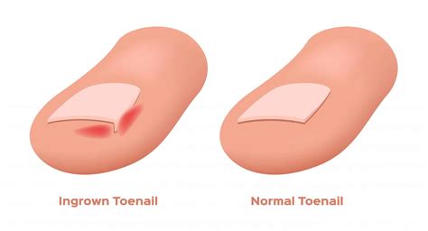 How To Avoid Ingrown Toenails The Foot Pod
