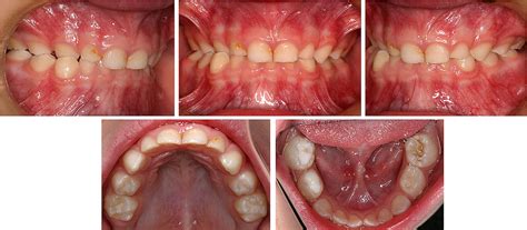Figure 1 From Posterior Crossbite In The Deciduous Dentition Period