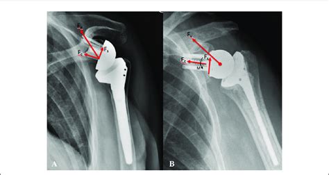 A Reverse Shoulder Arthroplasty Rsa Acting With A Fixed Cor With
