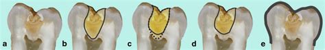 Removal Strategies A For Deep Carious Lesions In Teeth With Sensible