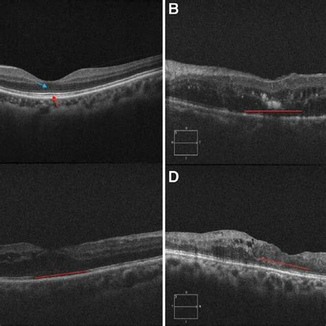 Representative Sd Oct Images A Horizontal Oct Image Of The Retina Of Download Scientific