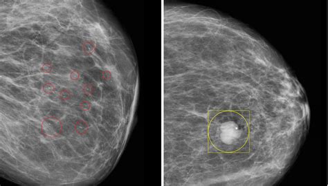 Calcification And Mass Abnormalities In Breast Mammogram Scans The