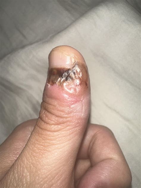 Dark Scab Forming After Draining Abscess From Severe Paronychia Rmedical