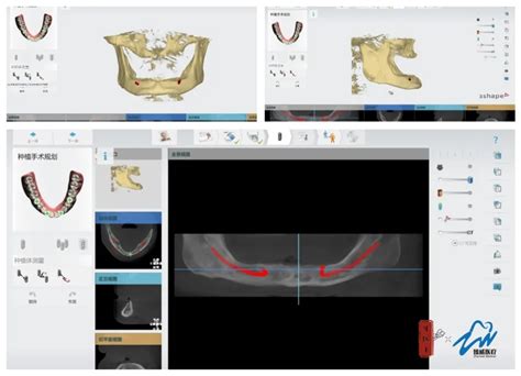 病例分享丨下颌ALL ON 4全数字化种植病例3D打印应用