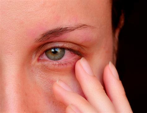 Intraocular Inflammation Assoc Prof Dr Kübra Şerefoğlu Çabuk