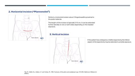 Pelvic And Hip Approach Pptx