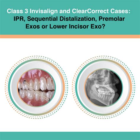 Class 3 Aligner Treatment Plans Ipr Premolar Exos Lower Incisor Exo Class 3 Aligner Treatment Plans Ipr Premolar Exos Lower Incisor Exo