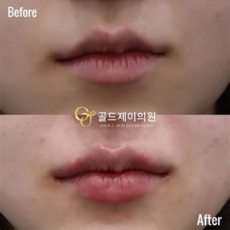 골드제이의원 골드제이만의 시그니처 입술필러💋 커스텀 입술필러입니다~ 옹졸해보이던 입술을 가로로