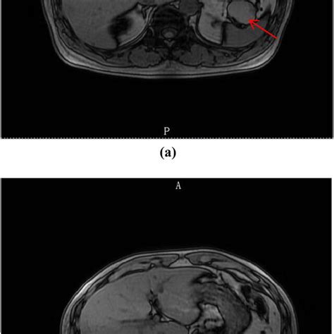 A B Mri Scan Of The Abdominal Space Occupying Lesion The Red Arrow