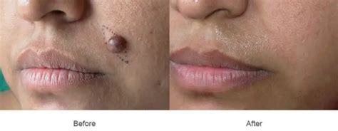 Mole Removal Surgery Before And After Photos Cosmetic Mole Removal