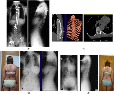 A Thirty Six Year Old Patient Who Had Undergone In The Past Segmental