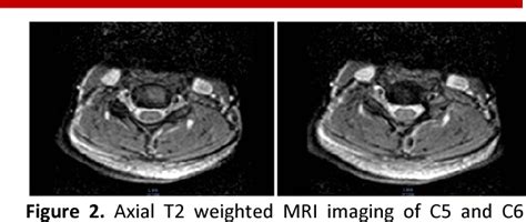 Figure 2 From Report Of Two Adult With Occult Cervical Spinal