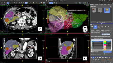 Liver Segmentation Package TeraRecon