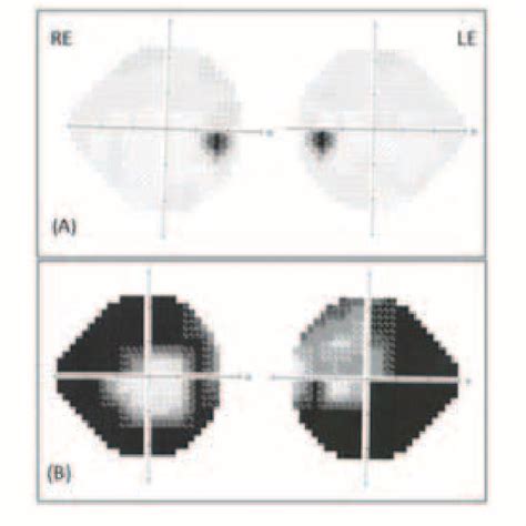 Humphrey 24 2 Visual Fields A Normal Visual Fields Found In October Download Scientific