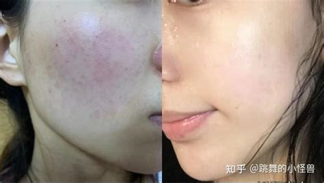 【高能预警】拯救敏感肌4步就能科学解决敏感肌带来的干燥、起皮、潮红、爆痘，简单、高效解决敏感肌！ 知乎