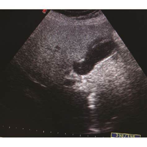 The Echogenic Debris In The Gallbladder Download Scientific Diagram