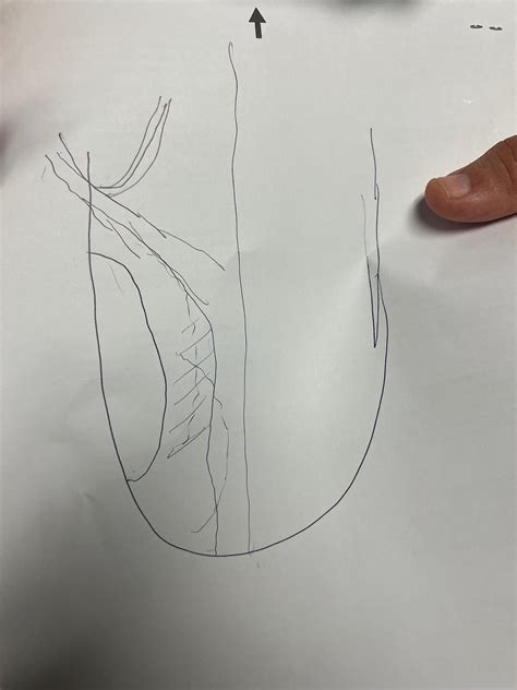 So Youre Having A Partial Glossectomy … By Scott Gordon Sep 2024