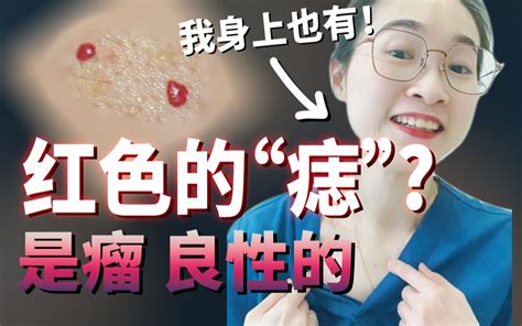 医生一分钟身上长红 痣 是血管瘤老了就可能出现 口口医生在这里 口口医生在这里 哔哩哔哩视频