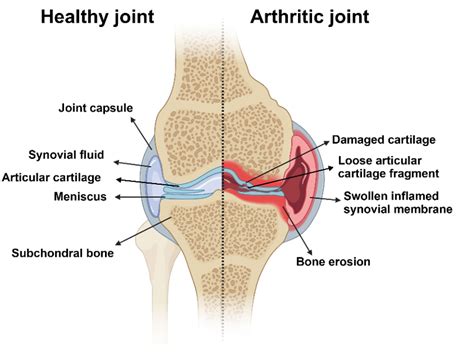 Synovial Fluid Extracellular Vesicles As Arthritis Biomarkers The