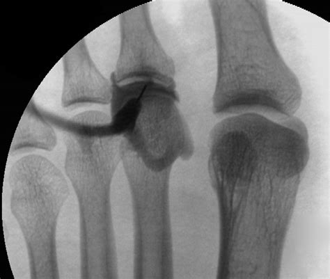 Mr Arthrography Of The Second And Third Metatarsophalangeal Joints For The Detection Of Tears Of