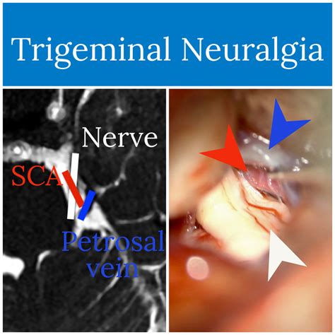 Trigeminal Neuralgia — Matthew Mian Md
