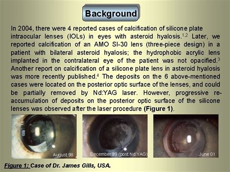 Calcification Of Different Designs Of Silicone Intraocular Lenses