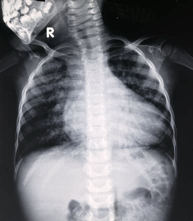 Tetralogy Of Fallot Radiology Case Radiopaedia Org