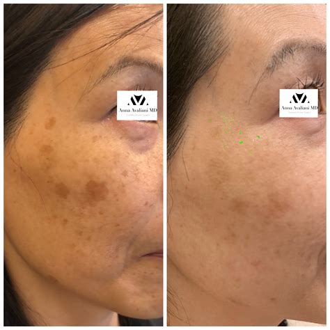 Img8510 Anna Avaliani Md Cosmetic And Laser Surgery Anna Avaliani Md