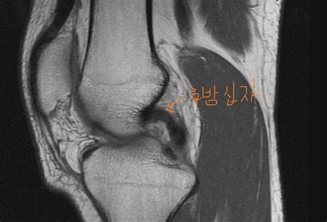 전방십자인대 반월상 연골 파열 Mri 사진 첨부 포텐 터짐 최신순 에펨코리아