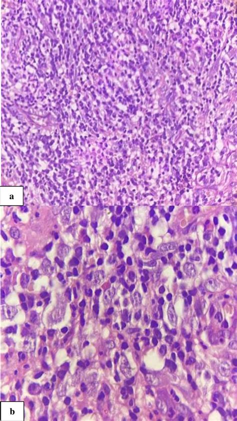 Polyp Lined By Endocervical Lining Scanner Download Scientific Diagram