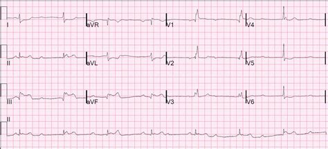 Dr Smiths Ecg Blog Intermittent Third Degree Heart Block Due To
