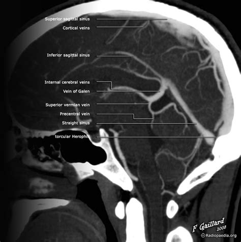Confluence Of Sinuses Radiology Reference Article Medical Radiography