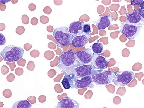 Marginal Zone Lymphoma In Bone Marrow Cytology Stock Image Image Of