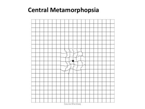 Amsler Grid Chart