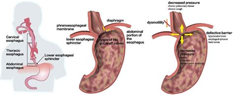 Current Advancement On The Dynamic Mechanism Of Gastroesophageal Reflux