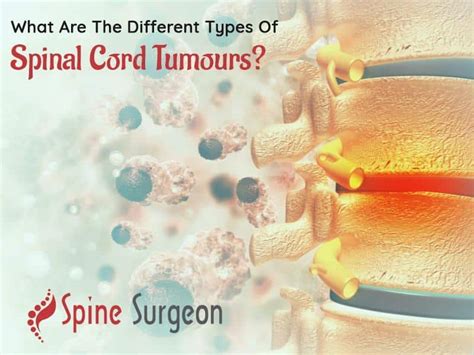 What Are The Different Types Of Spinal Cord Tumours Spine Surgeon