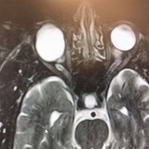 Finding My Niche With Myopia Management Review Of Myopia Management