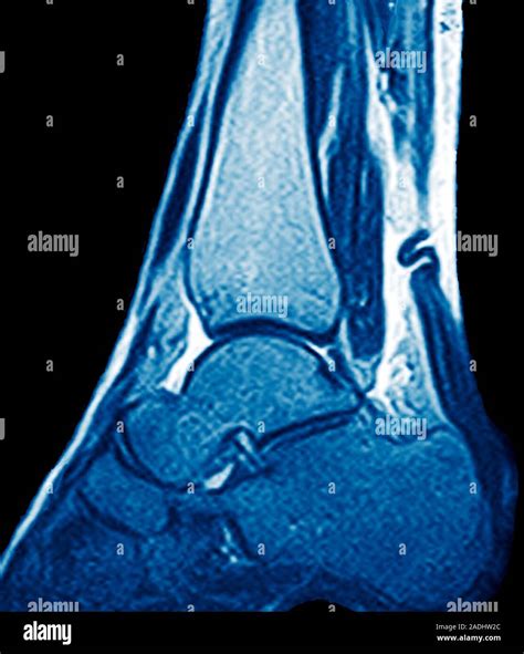 Achilles Tendon Mri Mri Blog Partial Tears Of Achilles Tendon