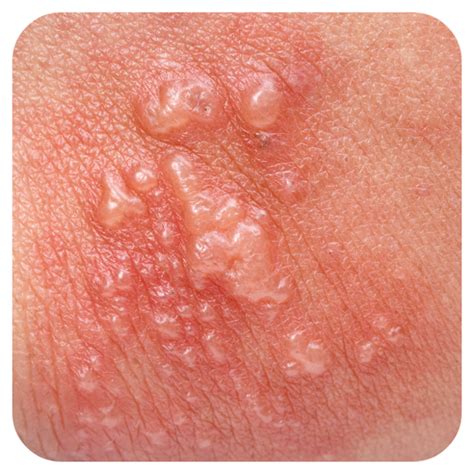 Hpv