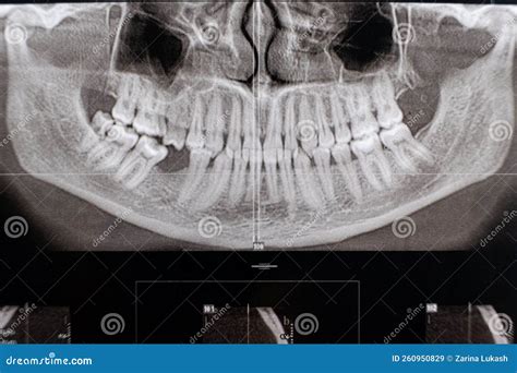 Ct Scan Of A Patient With Missing Chewing Tooth And Malocclusion Stock