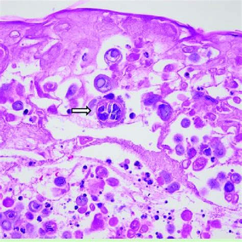 Multiple Vesicular Lesions On An Erythematous Base Download Scientific Diagram