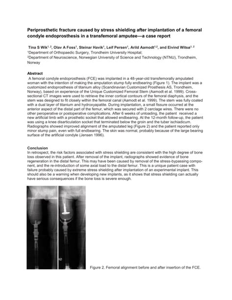Periprosthetic Fracture Caused By Stress Shielding After Implantation