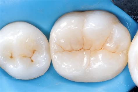 Handling Extensive Cavities In Cases Of Severe Tooth Decay
