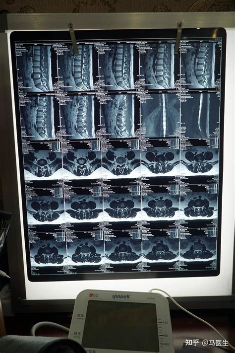 腰间盘突出手术后还疼怎么办 潍坊马先生为什么偷偷来沧州 知乎