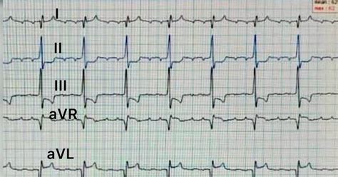 Atrial Tachycardia Or Atrial Flutter