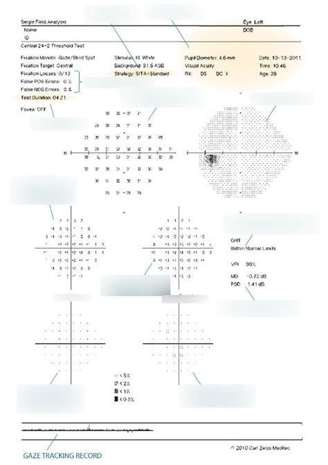 Visual Fields Perimetry Diagram Quizlet